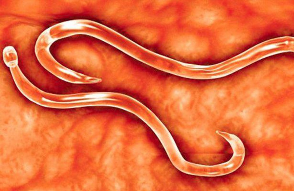 PHÁT HIỆN HÀNG TRĂM GIUN MÓC TRONG RUỘT THIẾU NIÊN